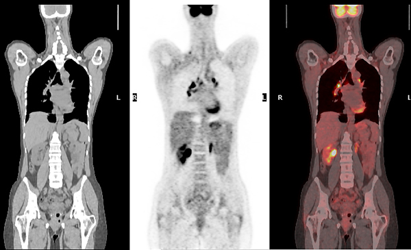 Cum funcționează PET-CT și cum îți poate salva viața